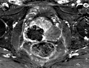 Treatment for prostate tumor : how does HIFU work ? - HIFU prostate