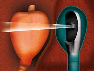 Treatment for prostate tumor : how does HIFU work ? - HIFU prostate